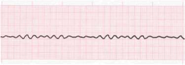 Cardioverter/ Defibrillator Implantation | Trillium Heart Rhythm